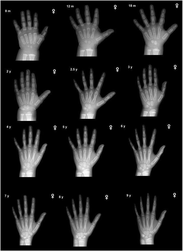 Bone Age Alchetron The Free Social Encyclopedia Bone Age Alchetron The Free Social Encyclopedia