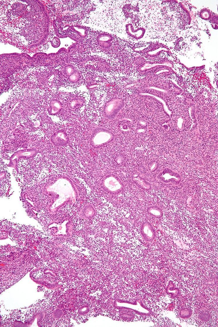 Endometrial Biopsy Alchetron The Free Social Encyclopedia Endometrial Biopsy Alchetron The Free Social Encyclopedia
