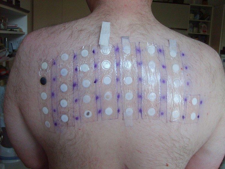 Patch Test Alchetron The Free Social Encyclopedia
